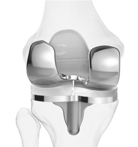 Maßgefertigte Knieprothese » Klinikum Siegen